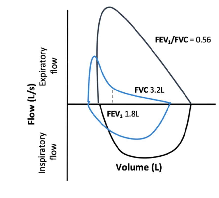 Approach to chronic obstructive pulmonary disease (COPD)