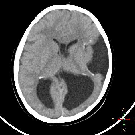 Congenital Cytomegalovirus Infection: Transmission, Diagnosis and Treatment