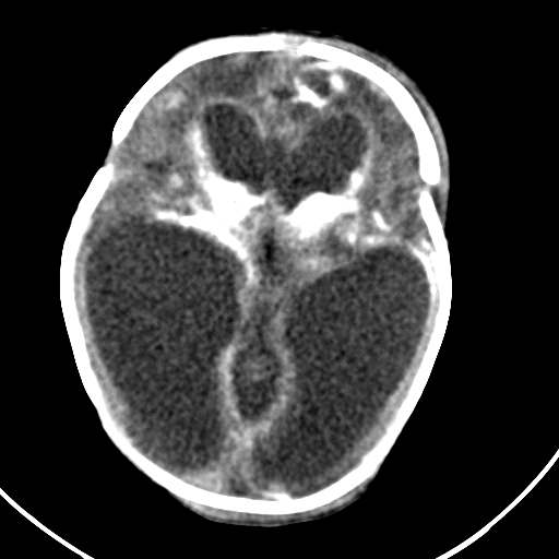 Congenital Cytomegalovirus Infection: Transmission, Diagnosis and Treatment