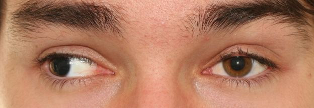 View of Approach to Strabismus | McGill Journal of Medicine