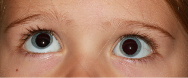 View of Approach to Strabismus | McGill Journal of Medicine