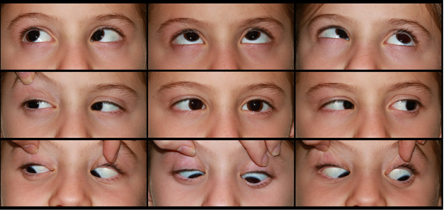Strabismus